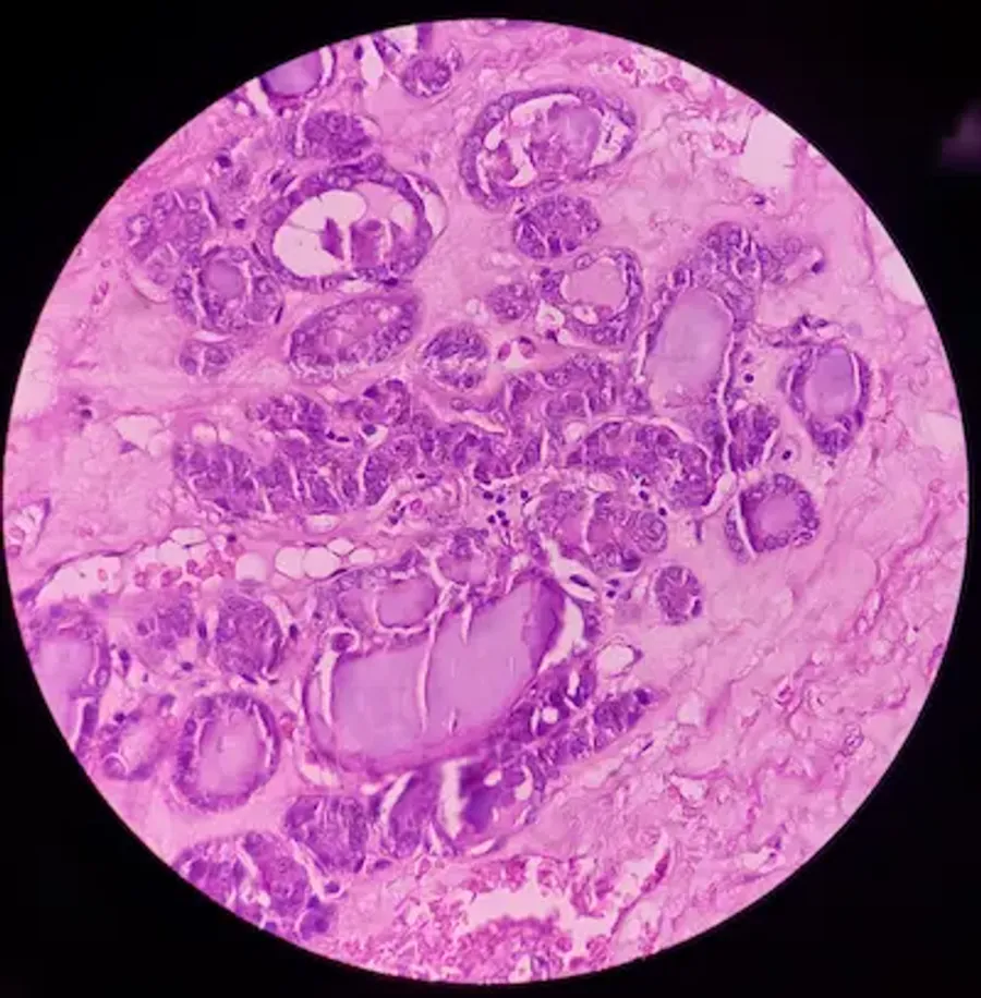 Thyroid Colloid Cyst: Symptoms, Causes, Diagnosis and More