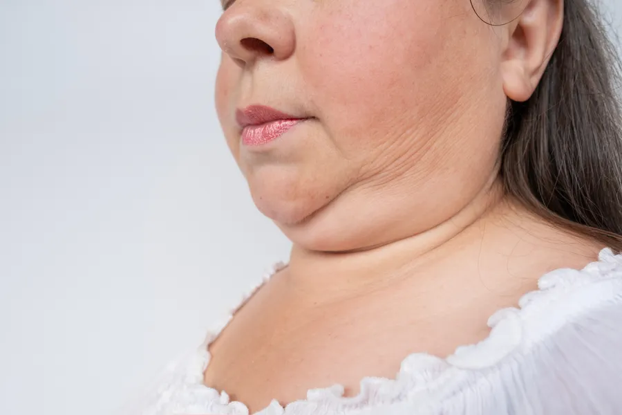 How To Reduce Neck Fat?