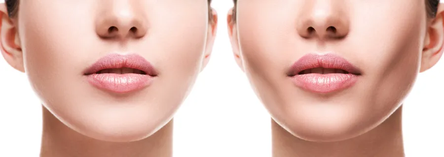 How To Reduce Cheek Fat?