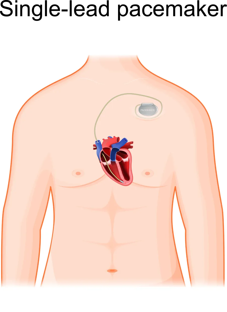 Understanding Pacemaker Complications: What You Need to Know