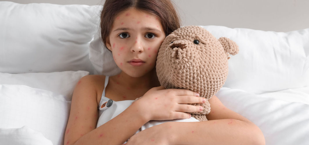 How To Care For Your Child When They Get Chickenpox?