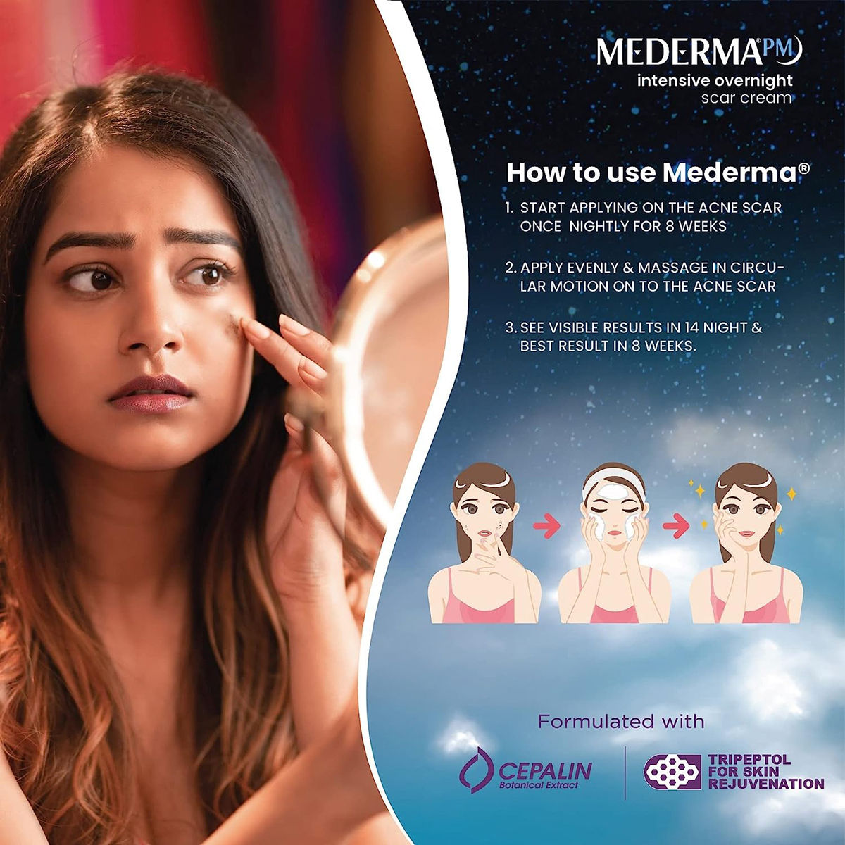 Mederma PM Intensive Overnight Scar Cream 30 gm Price, Uses, Side ...