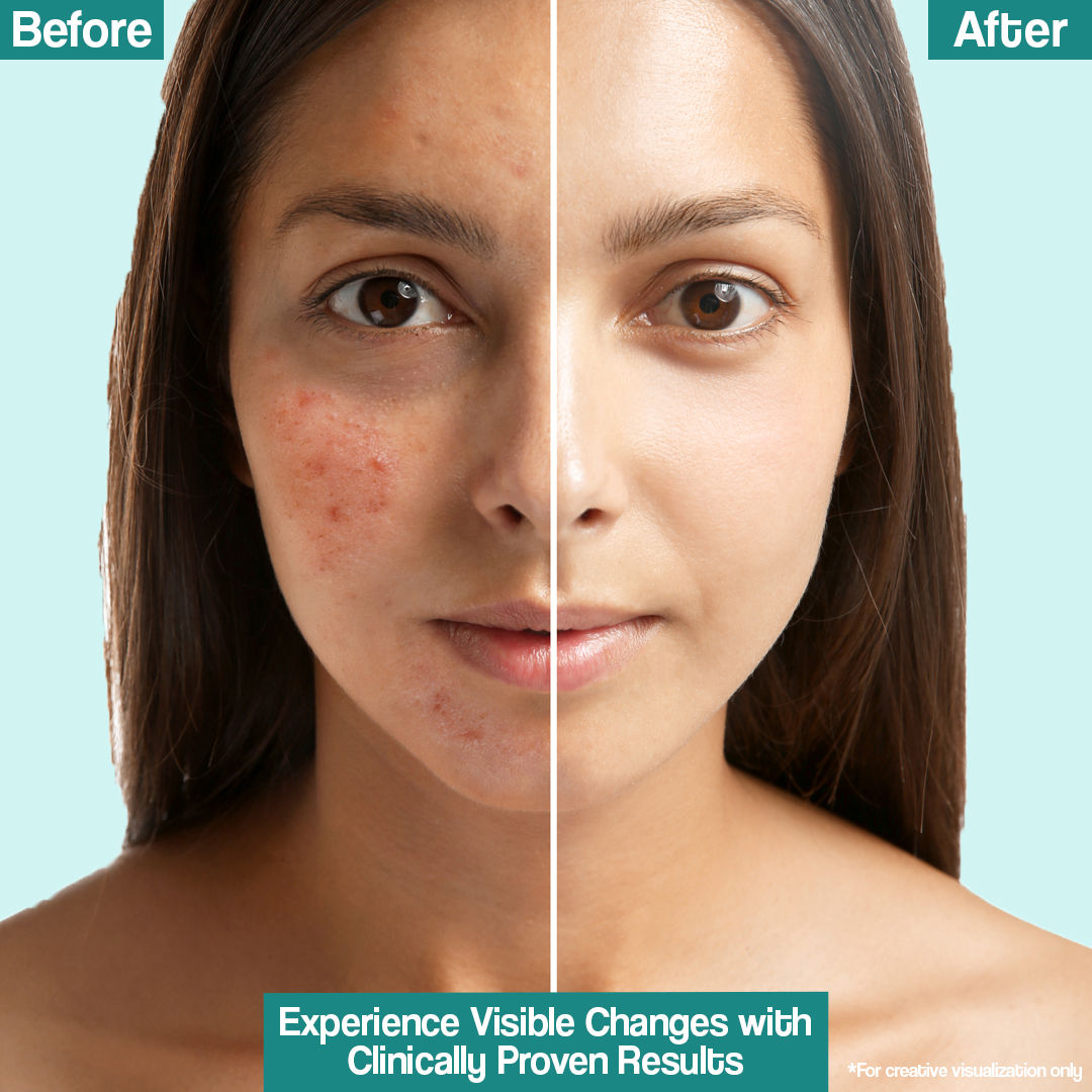 Venusia Acne Control Moisturizer Cream | Uses, Side Effects, Price ...