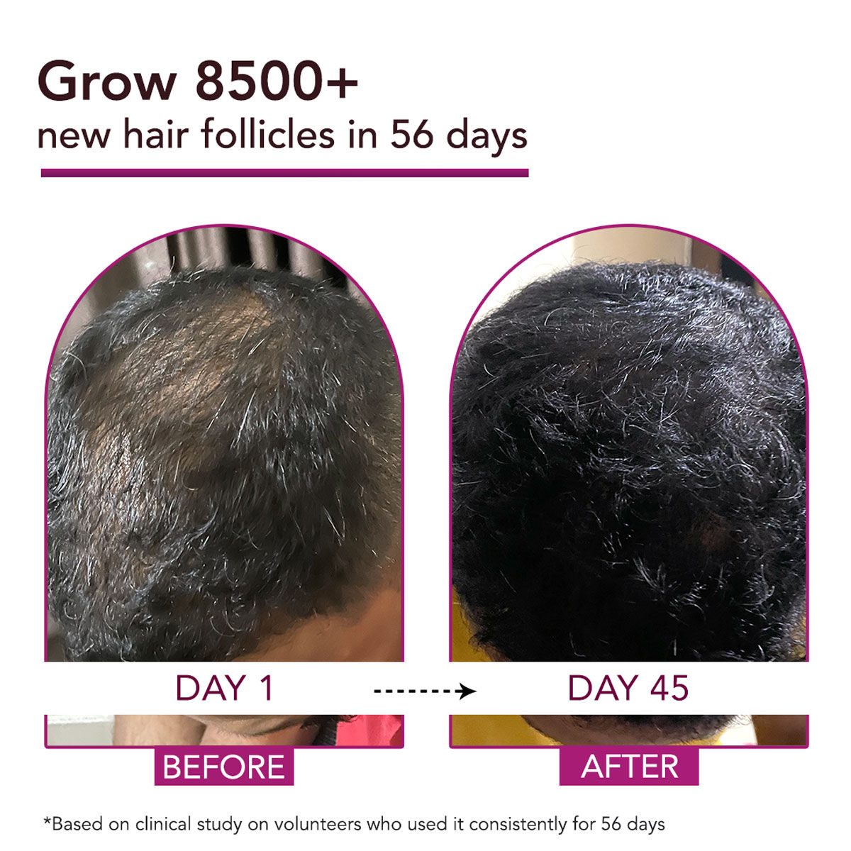 Bontress Pro+ Scalp Serum | Uses, Side Effects, Price | Apollo Pharmacy