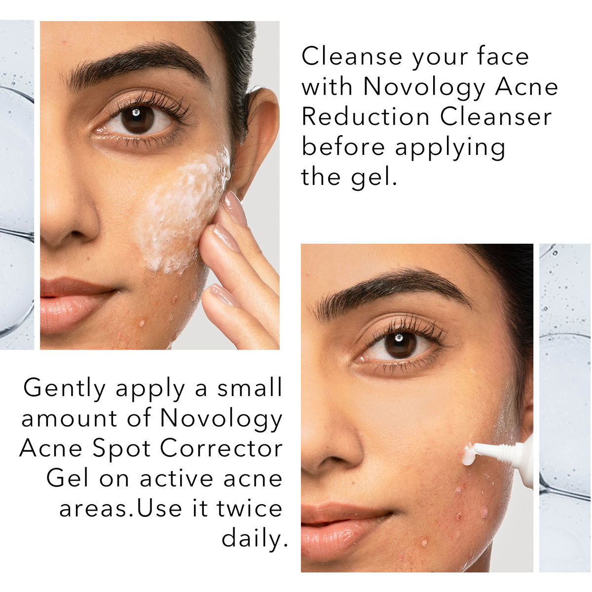 Novology Acne Spot Corrector Gel, 30 gm Price, Uses, Side Effects ...